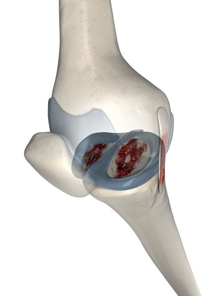 Self Tests for a Meniscus tear - Torn Knee meniscus? Get treatment today