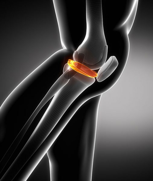 Self Tests for a Meniscus tear - Torn Knee meniscus? Get treatment today