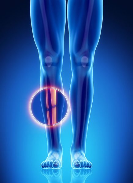 Shin Pain, Shin Injuries: Shin splints treatment - Physiotherapist Pretoria