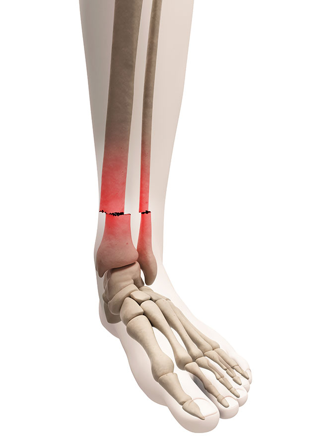 Torn Ligament: Types, Tests & Treatment - Ligament injury Physio Pretoria