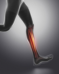 Shin Pain, Shin Injuries: Shin splints treatment - Physiotherapist Pretoria